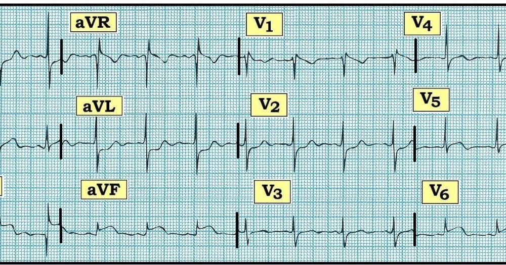 ECG Interpretation: ECG Interpretation Review #56 (ST Elevation - STEMI ...