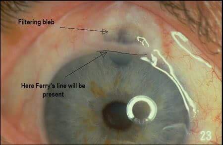 Ophthalmology Notes: Lines in Ophthalmology