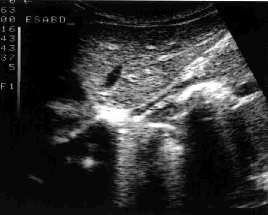 imagini ecografie esofag | Terapii naturiste si Tratamente