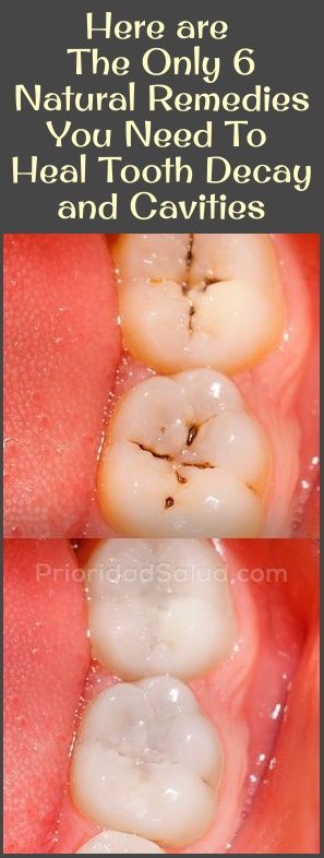 The Only 6 Natural Remedies You Need To Heal Tooth Decay and Cavities ...