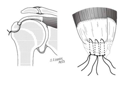 UW Shoulder and Elbow Academy: Rotator cuff tear - the value of open ...