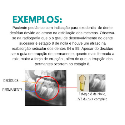 Canal da Odonto: CLASSIFICAÇÃO DE NOLLA