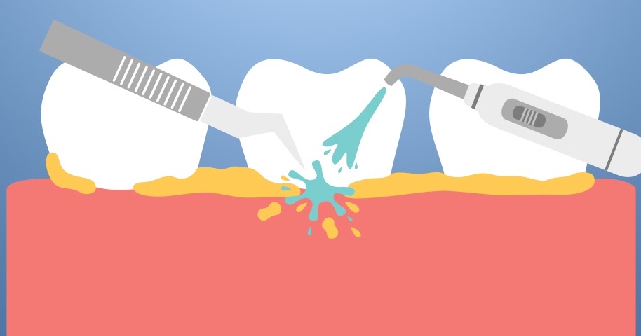 Dentistry in Singapore: Scale and Polish from the Dental Hygienist