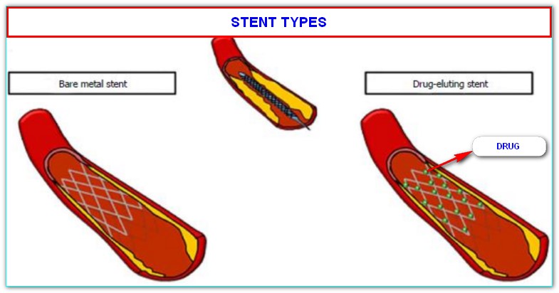 FACTS ABOUT STENT (ANGIOPLASTY OR PTCA)