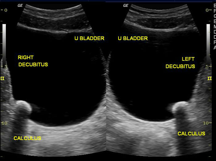 MEDICAL ULTRASOUND/ URINARY BLADDER STONE