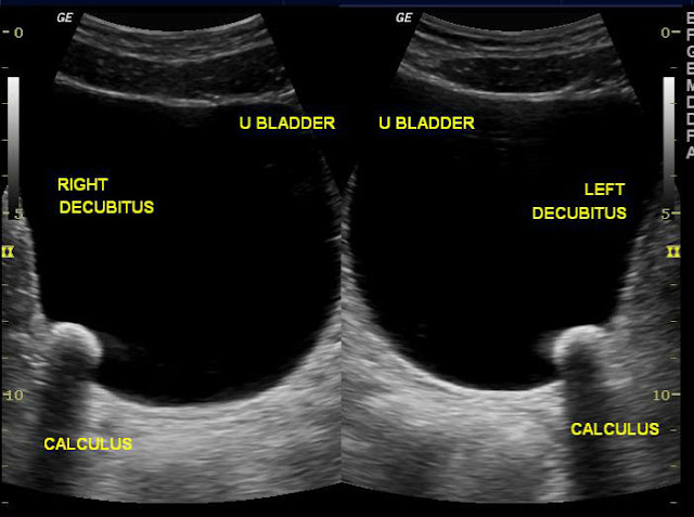 MEDICAL ULTRASOUND/ URINARY BLADDER STONE