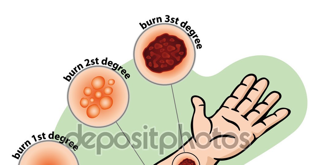 Quemaduras De Tercer Grado De Inflamabilidad Carbonizada