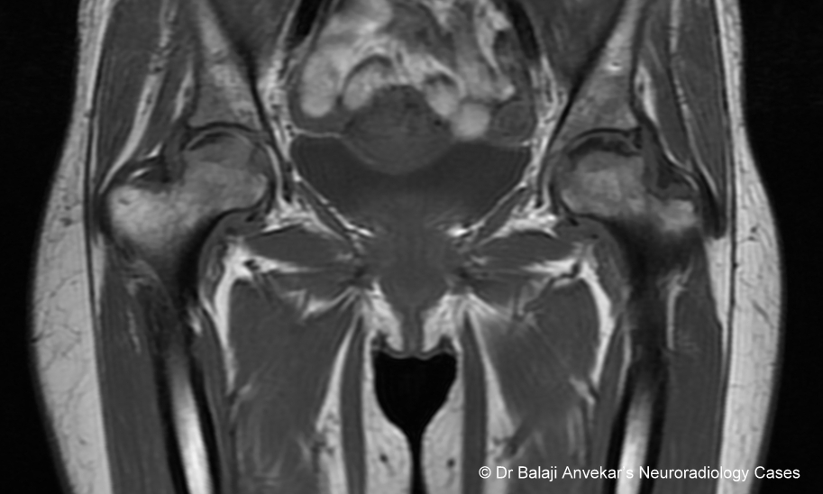 Dr Balaji Anvekar FRCR: Sickle Cell Anemia MRI
