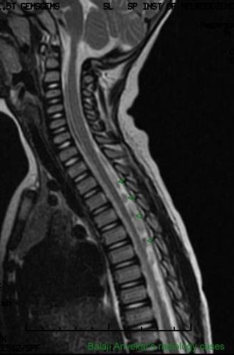 Dr Balaji Anvekar FRCR: Csf flow related artifact