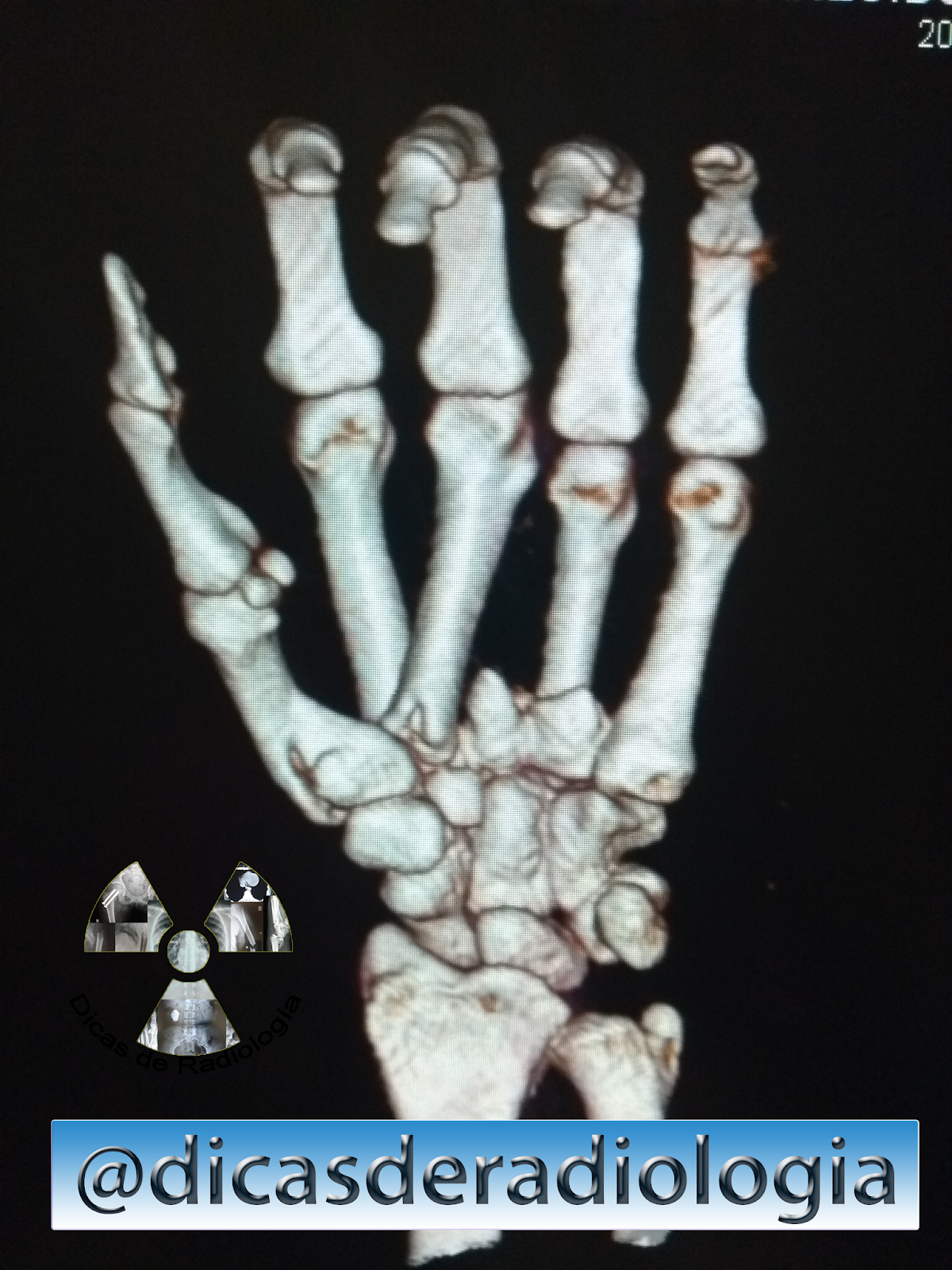 DICAS DE RADIOLOGIA - Tudo Sobre Radiologia: IMAGENS RADIOLÓGICAS DEMONSTRANDO FRATURA DA BASE ...