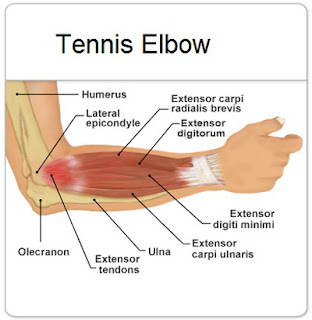 TENNIS ELBOW(LATERAL EPICONDYLITIS)