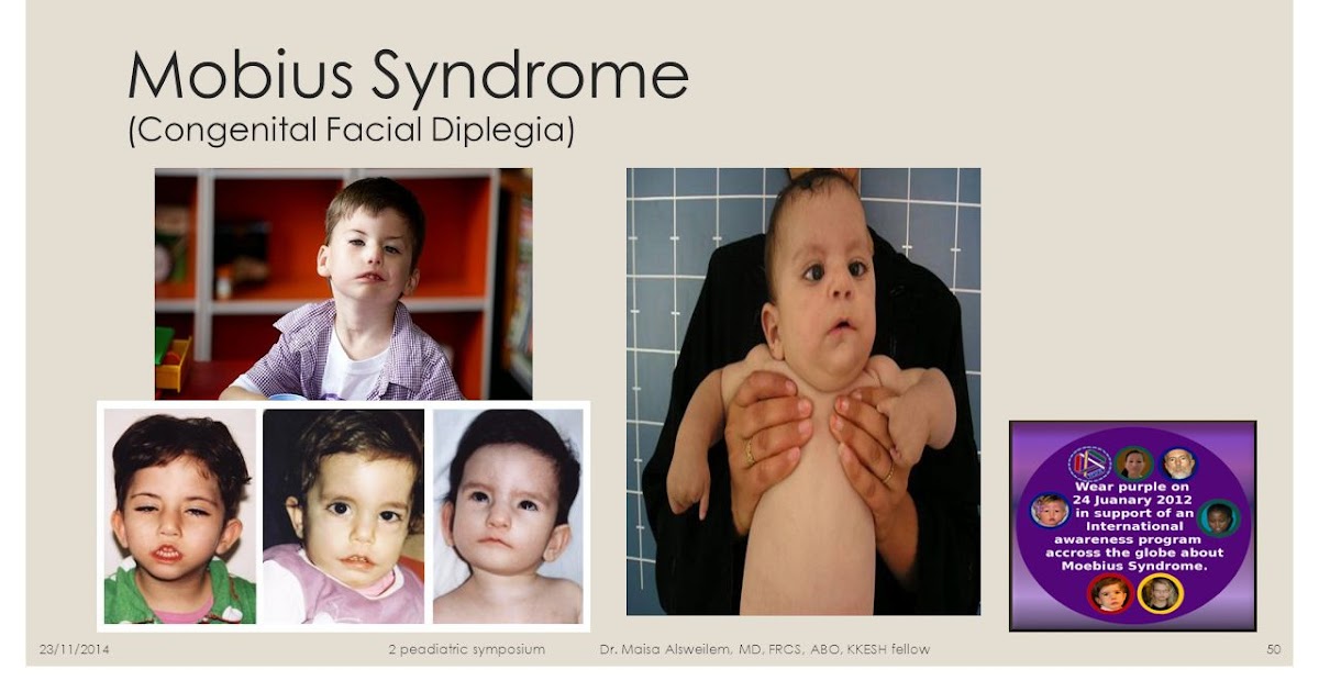 EXAMS AND ME : Moebius Syndrome