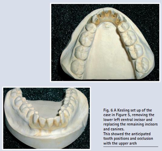 Dentistry lectures for MFDS/MJDF/NBDE/ORE: A NOTE ON- Extractions In ...