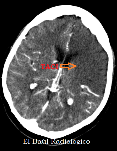 El Baúl Radiológico: ICTUS: UN GALIMATÍAS DE SIGLAS (Stroke: A ...