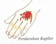 Perdarahan & Syok - Manajemen K3 Umum