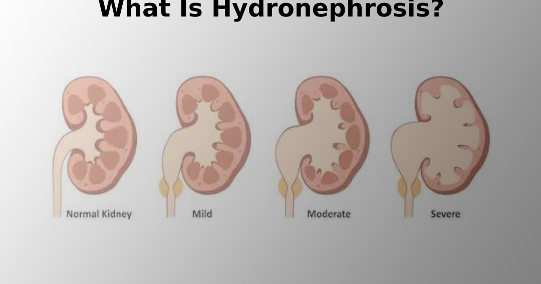 What is hydronephrosis? - Hydroneprosis Ayurvedic Treatment - Ayurvedic ...