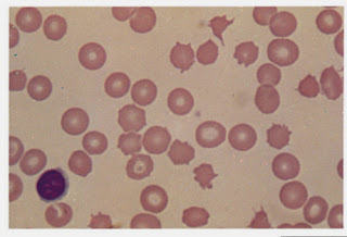 Hematología Heber mayen 2015: Alteraciones Eritrocitarias