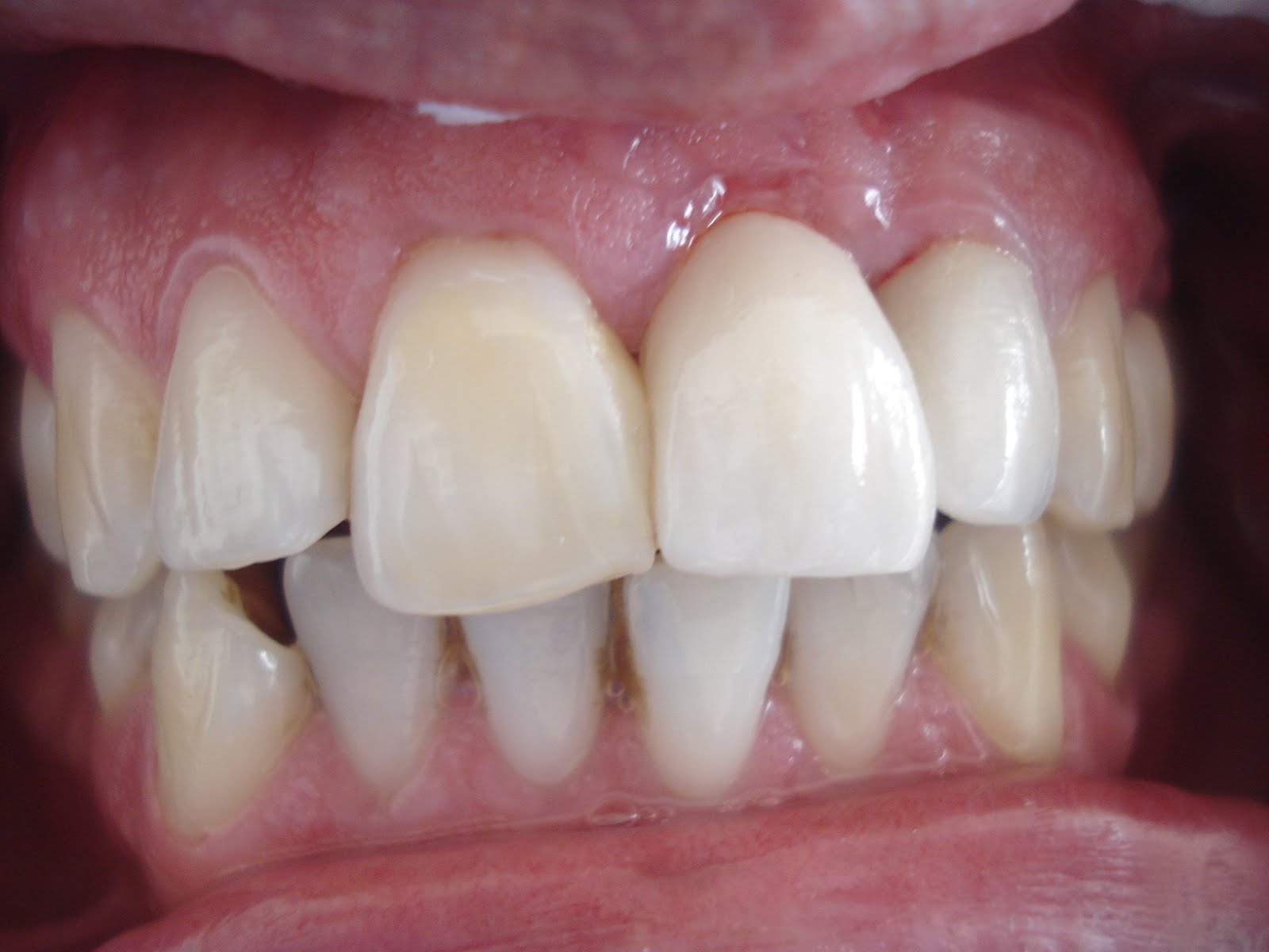 Odontología hoy: IMPLANTE UNICO EN 21 - CORONA ZIRCONIO