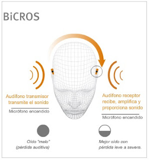 Prótesis auditiva y dispositivos de ayuda: SISTEMA CROS Y BICROS