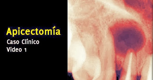 APICECTOMÍA: Cirugía Periapical - Caso Clínico (Video 1) - Odonto-Tv
