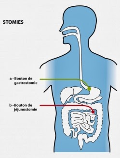 Récap' IDE: Les stomies digestives