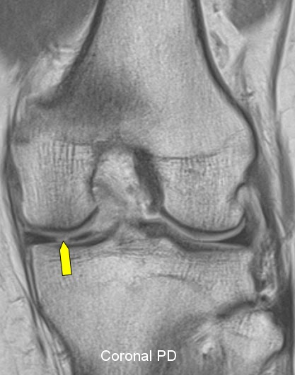 mricases: Radial Meniscal tear