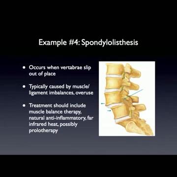 MAKLUMAT KESIHATAN DAN PENYAKIT: Sakit Saraf Sciatica 1 (urat di antara ...