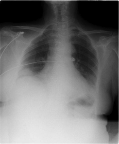 EPÓNIMOS: ENFERMEDAD DE BAMBERGER II