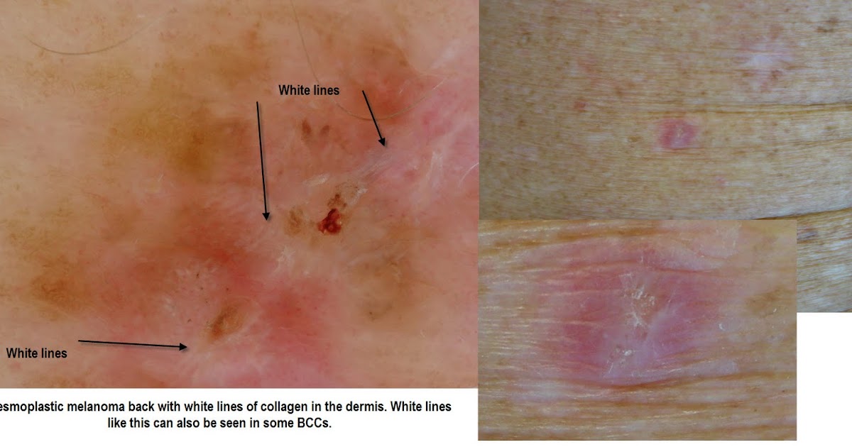Dermoscopy Features as Clues: White lines