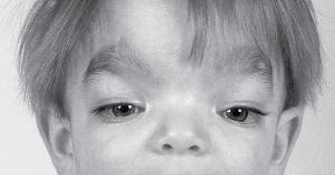 Stranger diseases: SÍNDROME DE AARSKOG-SCOTT