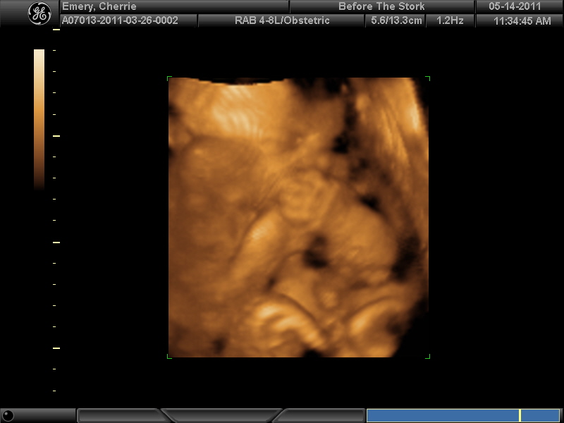 Making mEmerys: 3D/4D Ultrasound-30 Weeks