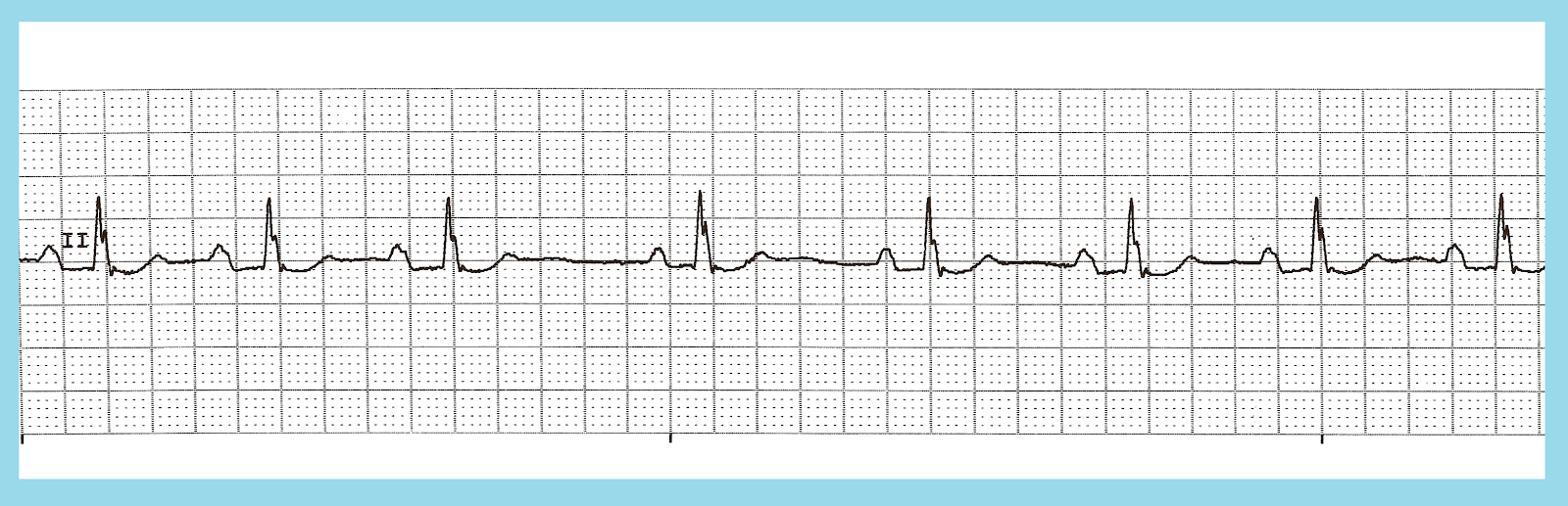 Various Sinus Arrhythmias