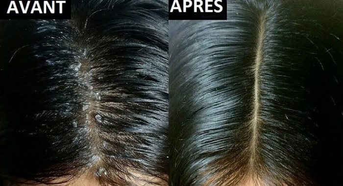 Comment se débarrasser des pellicules sèches et grasses