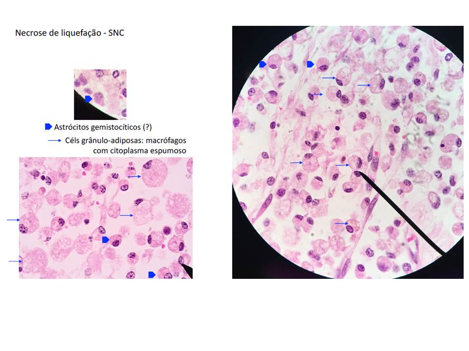 HISTOLOGIA90: TIPOS DE NECROSE