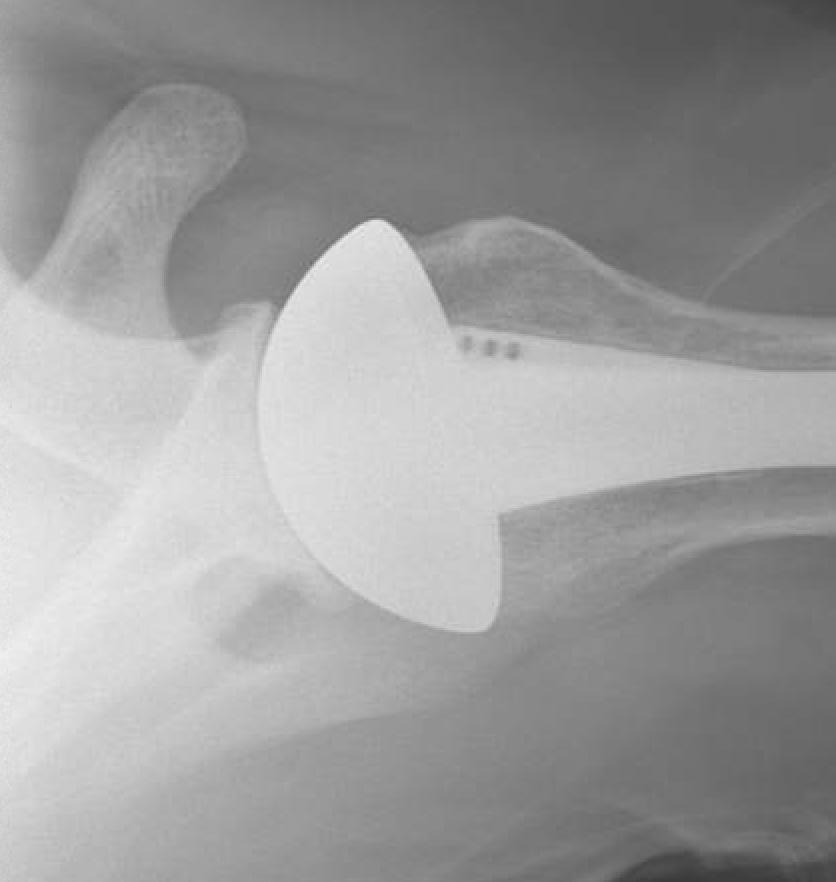 UW Shoulder and Elbow Academy: Return to pitching after a ream and run ...