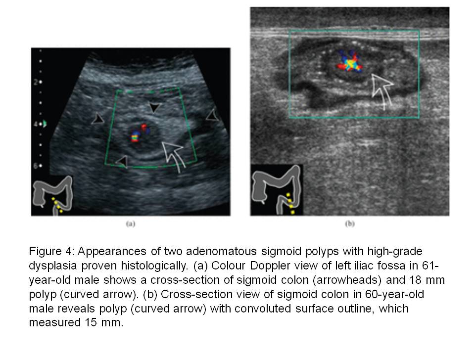 BÀI SOẠN VỀ SIÊU ÂM CHẨN ĐOÁN: COLONIC POLYPS: US DETECTION