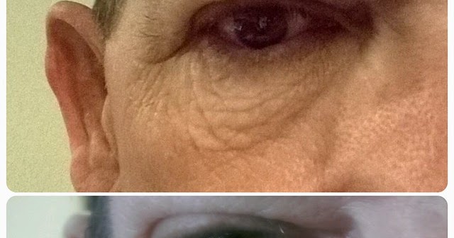 What Causes Eye Bags And Puffiness what-causes-eye-bags-and-puffiness
