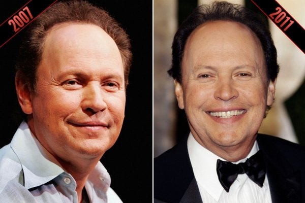 Billy Crystal Plastic Surgery