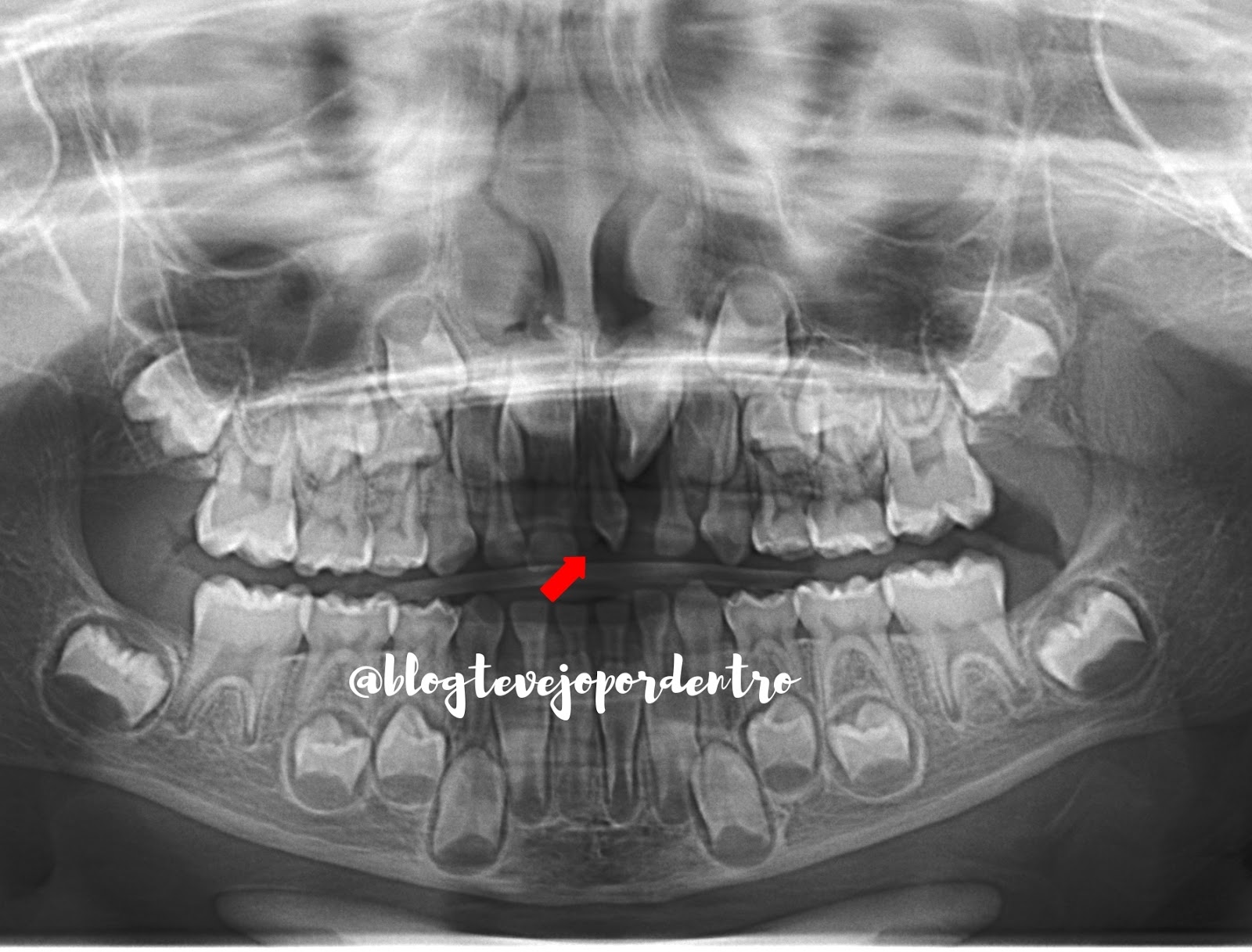 "Te vejo por dentro": Mesiodens