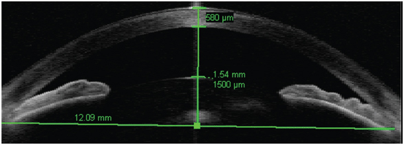 Cátedra N° 11 - OCT de polo anterior