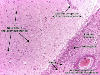 Histology and Explanation of Purulent Meningitis | MEDICAL CHOICES