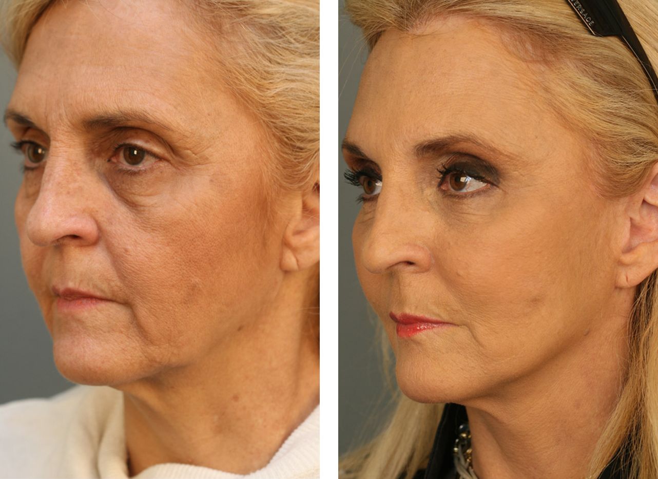 Face Toning Workouts Towards A Natural Nodal Facelift: Trim Nasolabial ...