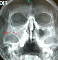DICAS DE RADIOLOGIA: IMAGENS RADIOLÓGICAS - COMO IDENTIFICAR A SINUSITE ...