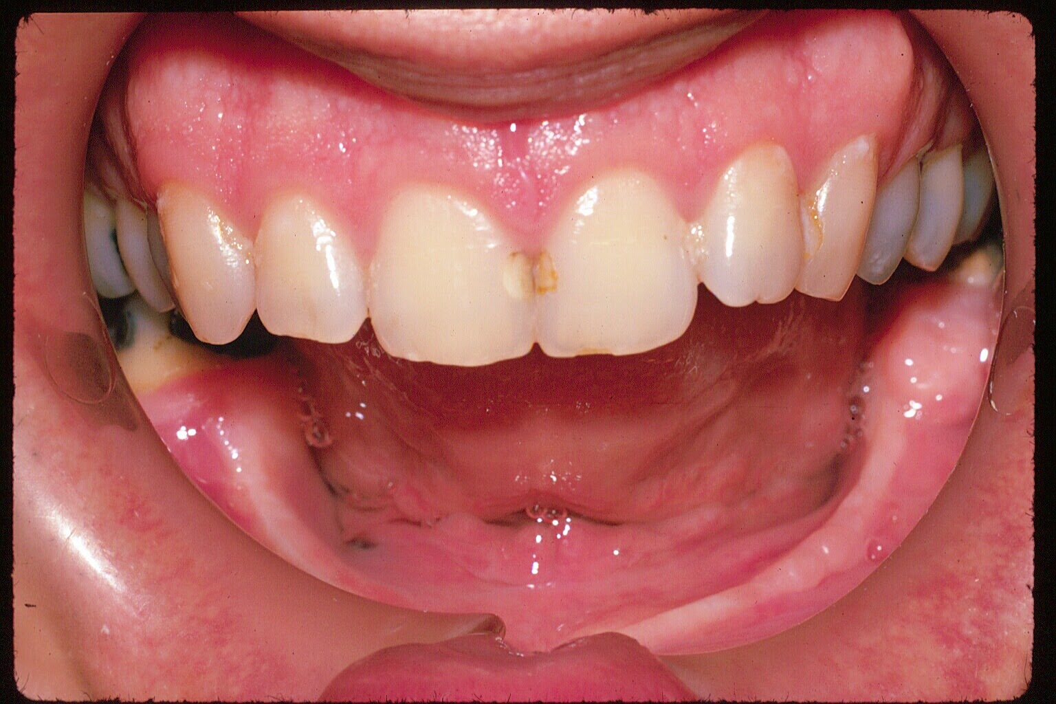 Dr. Robert G. Tupac: Prosthodontics: Prosthodontists Restore Surgical ...