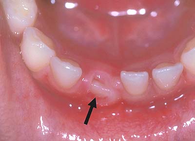 PORUR TOOTH CENTRE: Teething - Teething and Eruption