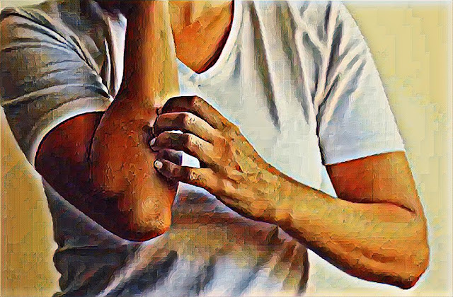 Dermatitis Seboroik: Pengertian, Faktor Risiko, Penyebab, Gejala ...