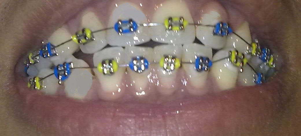 Mr Braces 7Eleven: Appt Tukar Getah Braces - Blue & Yellow