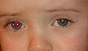 EcuadorMundo Vision - A Charitable Foundation: What is The Red Reflex ...