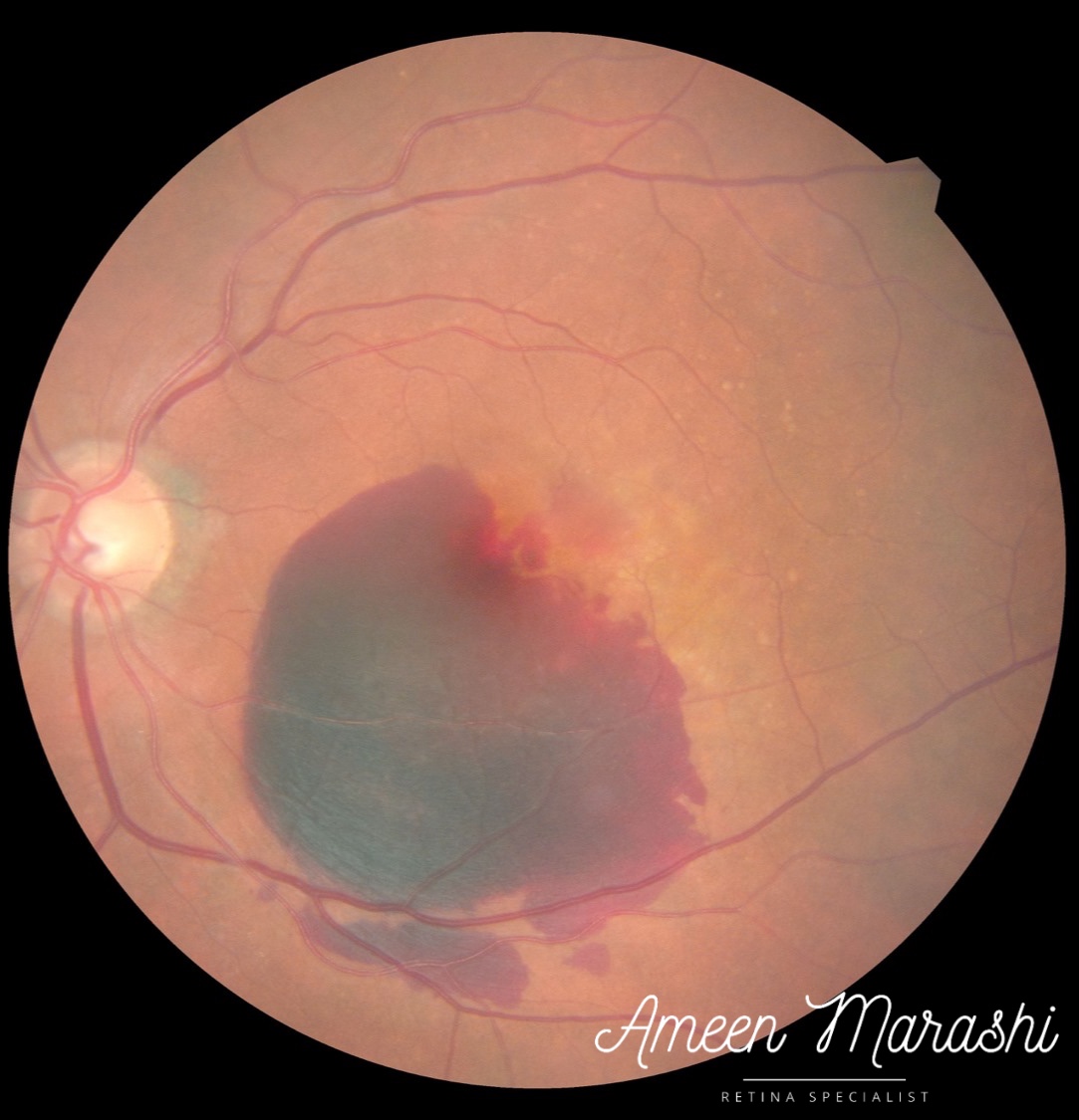 Subretinal hemorrhage case report
