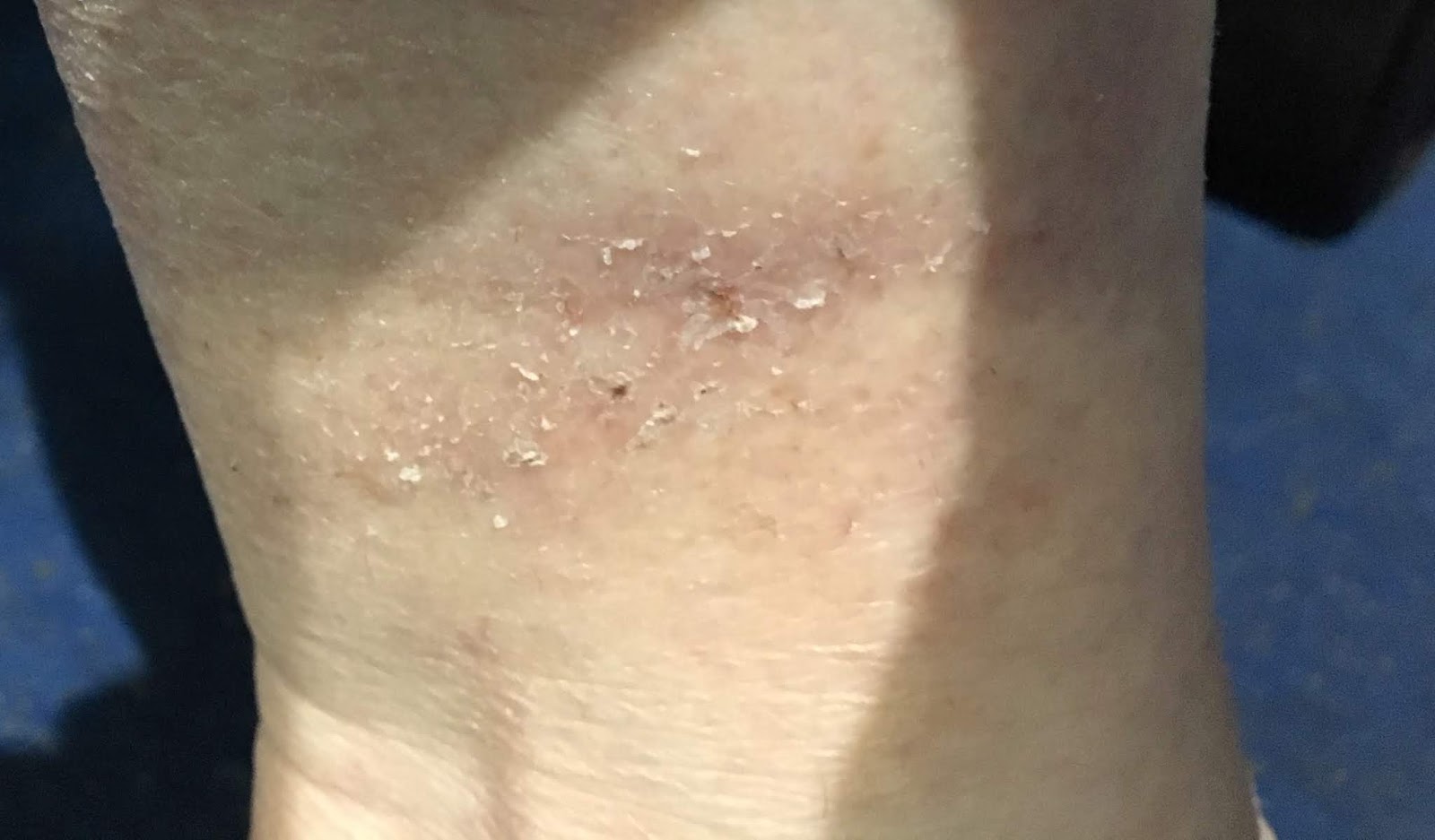 The Ice Doesn't Care: Skating Boot Burn